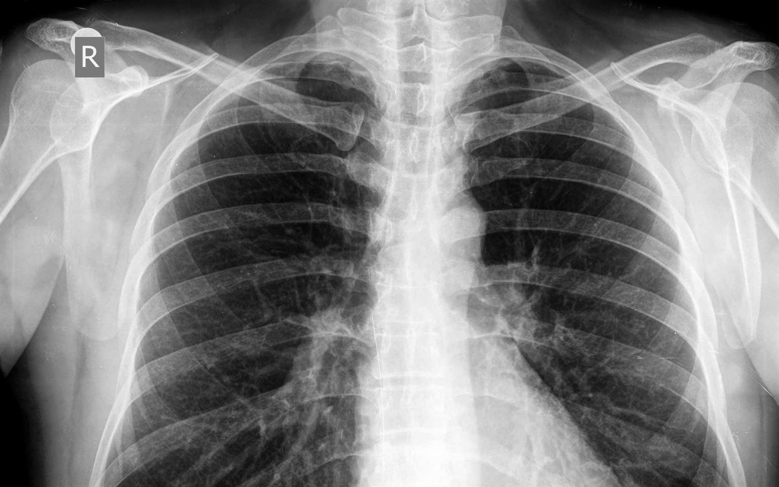 RADLogics Announces FDA Clearance and Validation for AI-Powered ... RADLogics Announces FDA Clearance and Validation for AI-Powered ...